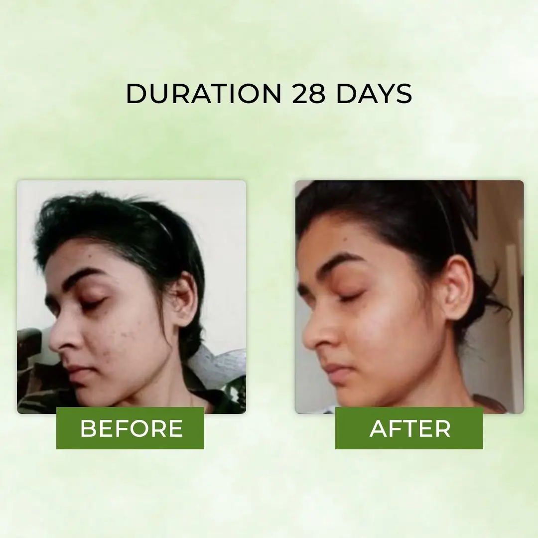 Pimple Fighter Soap (75g) - Araah Skin Miracle