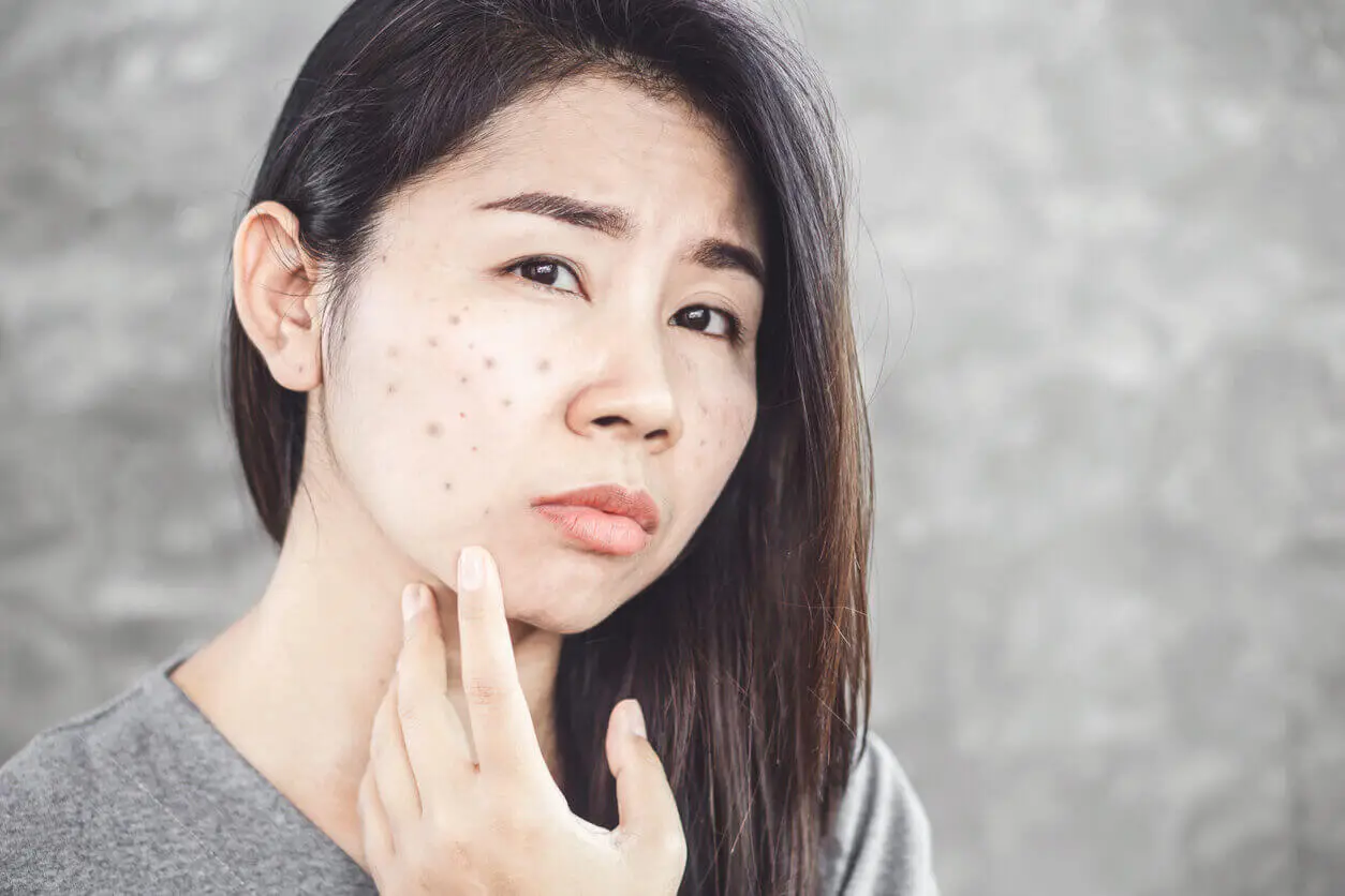 Get Rid Of Dark Spots With These Natural Solutions Get Rid Of Dark Spots With These Natural Solutions